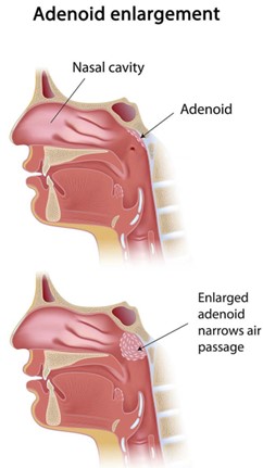 Management of Enlarged and Infected Adenoids - PrudENT Rhinoplasty and ...
