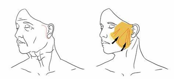 Macs Lift - PrudENT Rhinoplasty and Facial Cosmetic Surgery
