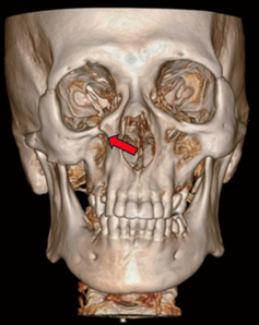 Facial Fractures - PrudENT Rhinoplasty and Facial Cosmetic Surgery